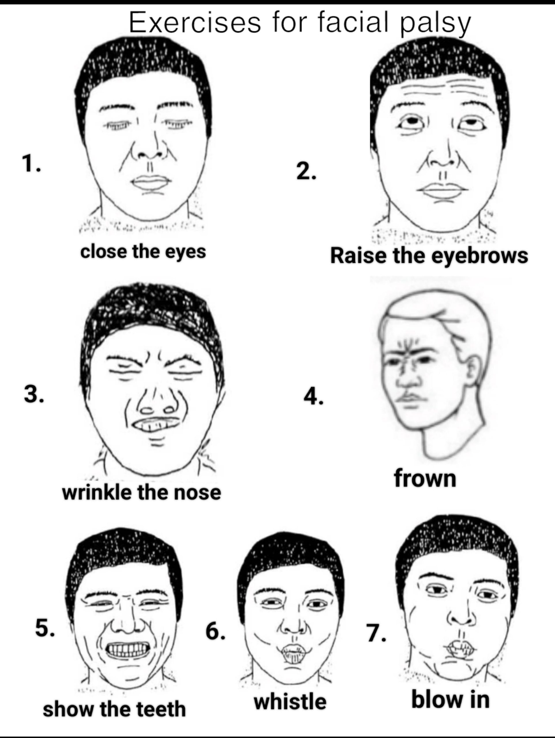 Exercises for Facial Palsy /Bell’s Palsy– Improve Facial Movement